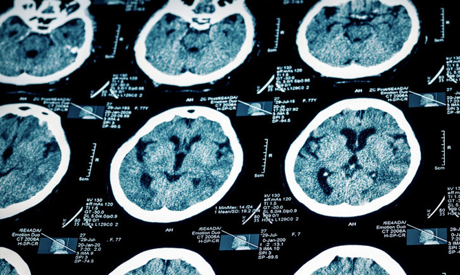 4 Ways Medical Marijuana Can Help Your Brain