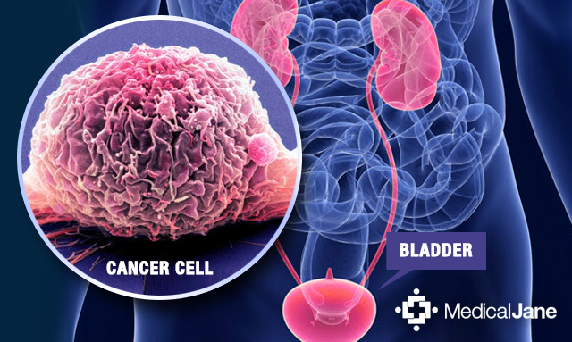 Study: Whole-Plant Cannabis Use vs. Bladder Cancer